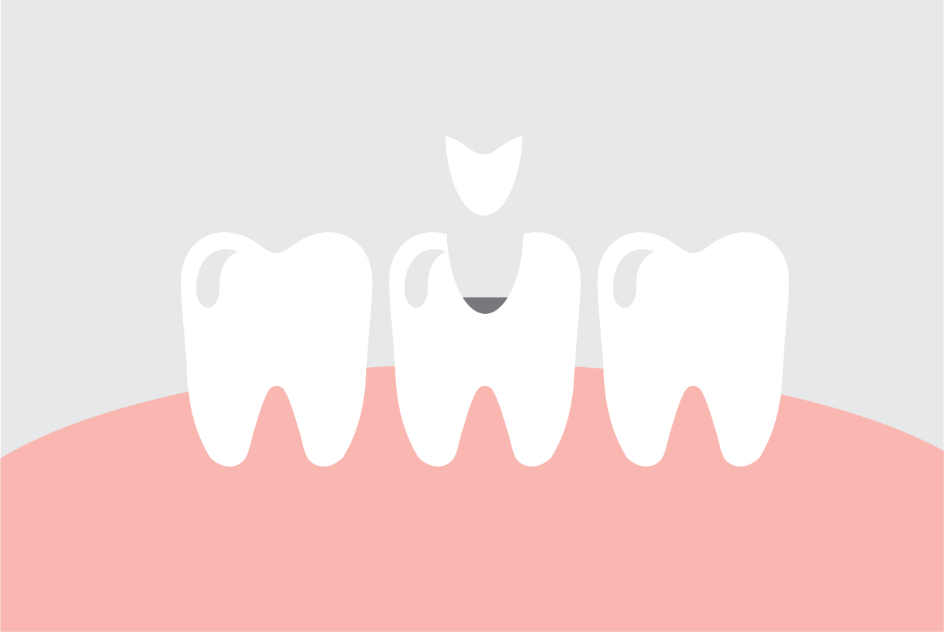 Affordable Dental Fillings | Johnson Family Dental
